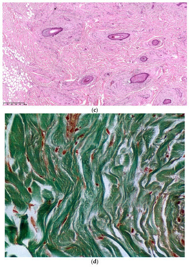 Histological Patterns of Skin Lesions in Tuberous Sclerosis Complex: A ...