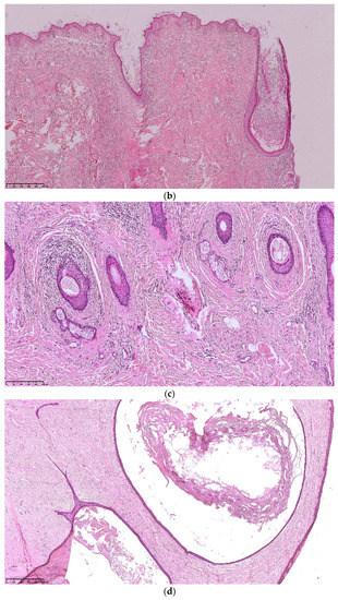 Histological Patterns of Skin Lesions in Tuberous Sclerosis Complex: A ...