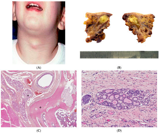 Diagnostic Approach to Congenital Cystic Masses of the Neck from a ...