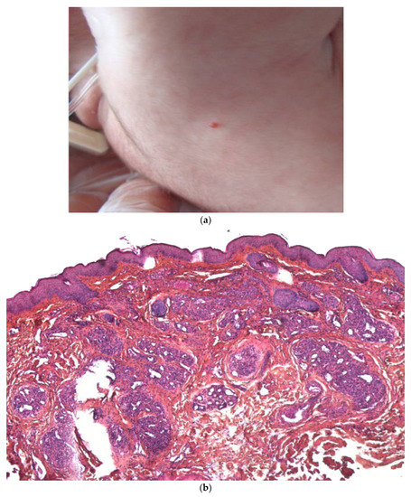 What to Look Out for in a Newborn with Multiple Papulonodular Skin ...