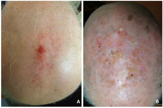 Erosive Pustular Dermatosis of the Scalp: A Clinicopathologic Study of ...