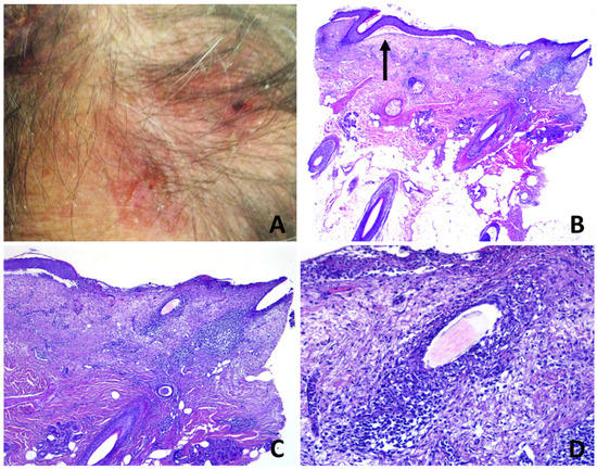 Erosive Pustular Dermatosis of the Scalp: A Clinicopathologic Study of ...