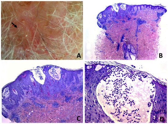 Erosive Pustular Dermatosis of the Scalp: A Clinicopathologic Study of ...
