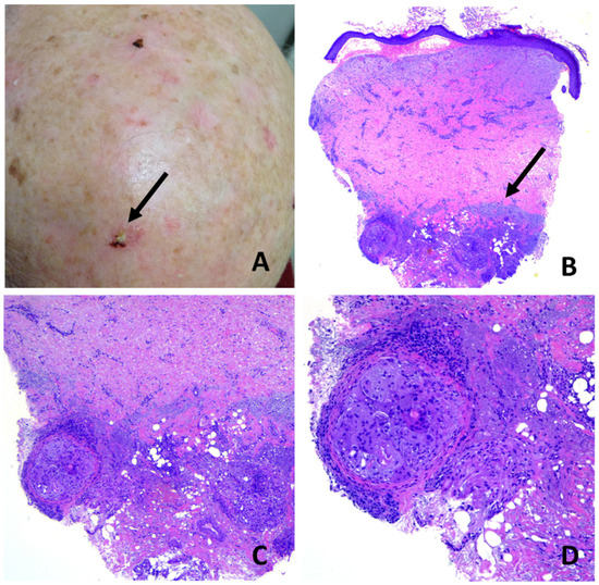 Erosive Pustular Dermatosis of the Scalp: A Clinicopathologic Study of ...