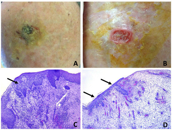 Erosive Pustular Dermatosis of the Scalp: A Clinicopathologic Study of ...