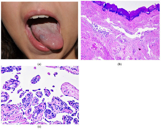 Venous Malformations in Childhood: Clinical, Histopathological and ...