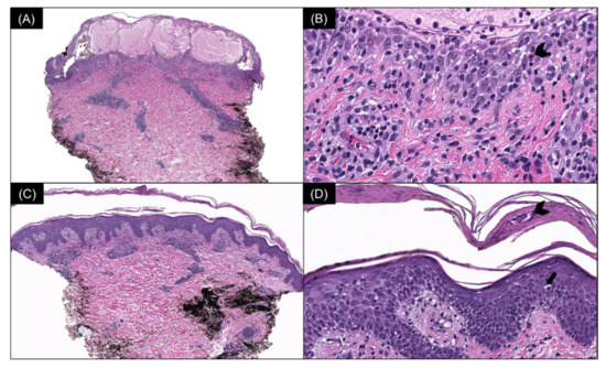 Pityriasis Lichenoides et Varioliformis Acuta as a Complication of ...
