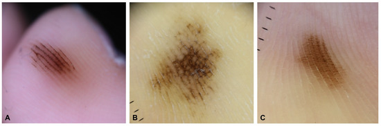 Dermatopathology | Free Full-Text | Acral Melanocytic Neoplasms: A ...