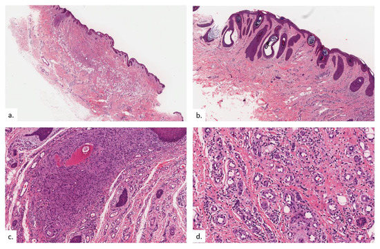 Reactive Epidermal Hyperplasia and Angiogenesis of the Rear (REAR): A ...