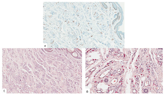 Reactive Epidermal Hyperplasia and Angiogenesis of the Rear (REAR): A ...