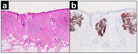 Recurrence of a Cellular Blue Nevus with Satellitosis—A Diagnostic ...