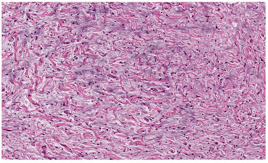 Histopathological Variants of Cutaneous Neurofibroma: A Compendious Review