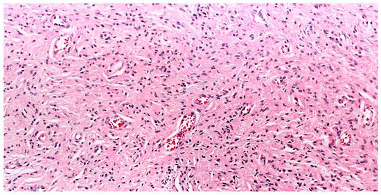 Traumatic Neuroma Pathology Outlines