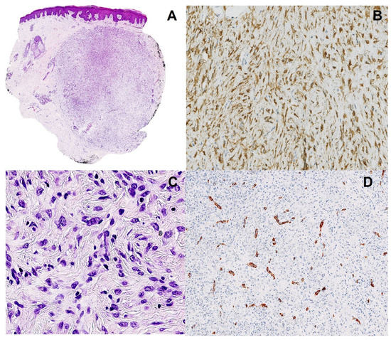 Epithelioid Fibrous Histiocytoma with CARS-ALK Fusion: First Case Report