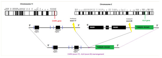 Epithelioid Fibrous Histiocytoma with CARS-ALK Fusion: First Case Report