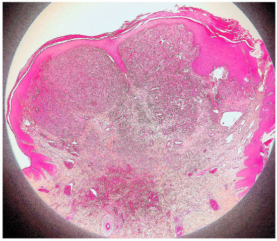 Cutaneous Epithelioid Angiomatous Nodule: Report of a New Case and ...