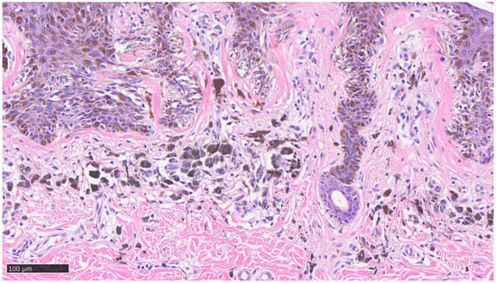 Is It Time to Supersede the Diagnostic Term “Melanoma In Situ with ...