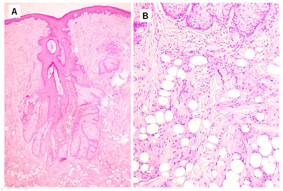 Dermatopathology | Free Full-Text | Folliculosebaceous Cystic Hamartoma ...