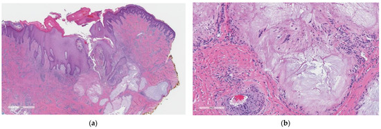 Dermatopathology | Free Full-Text | Perforating Gout: Expanding the ...
