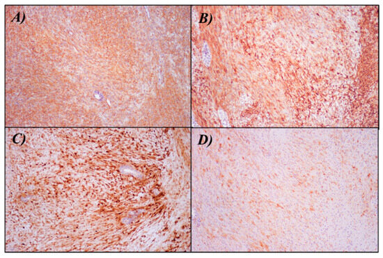 Cutaneous Syncytial Myoepithelioma with Positive CD34 ...