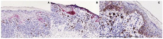 Lichen Planus Pigmentosus with True Melanocytic Nests: A Case Report with a Comprehensive ...