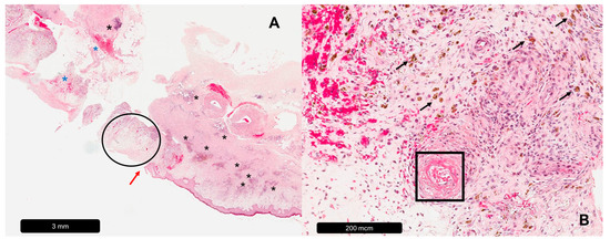 The Histopathology of Leg Ulcers