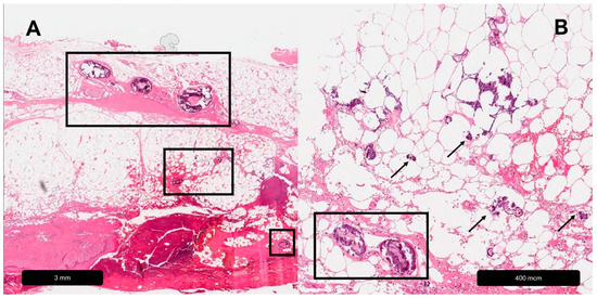The Histopathology of Leg Ulcers