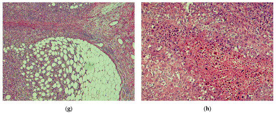 Histopathologic Evaluation of Atypical Fibroxanthoma or Pleomorphic ...