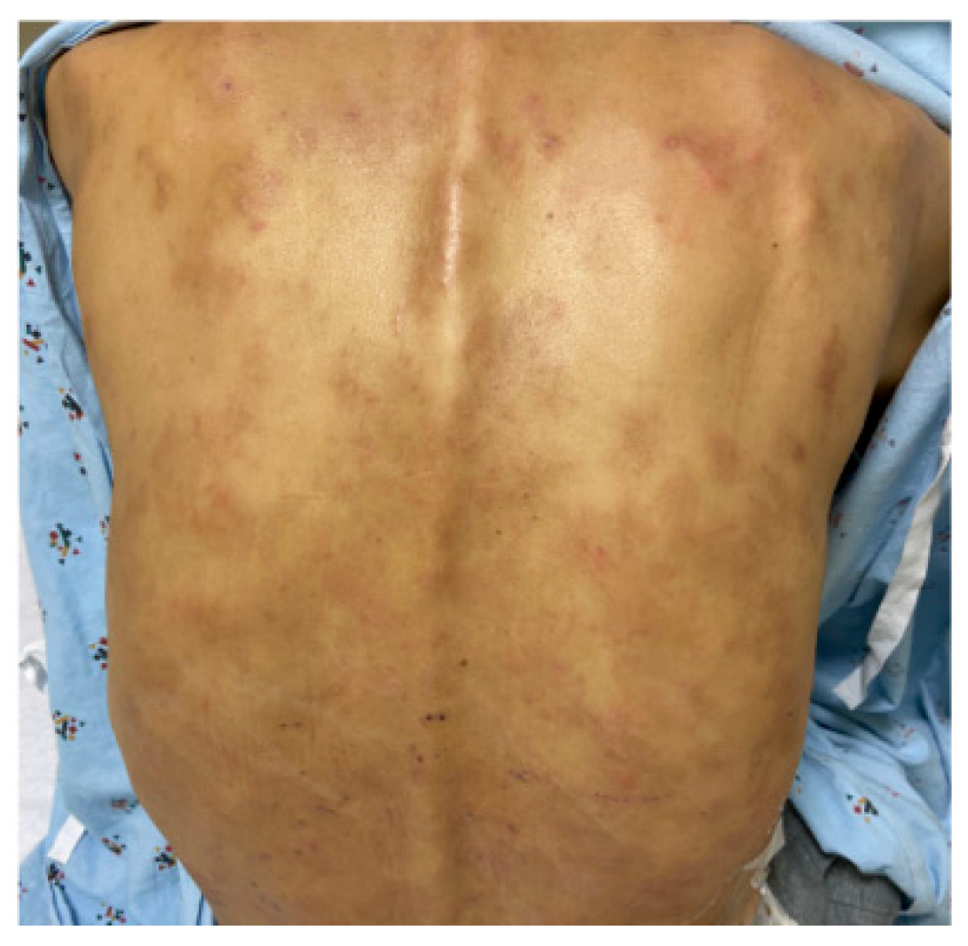 Dermatopathology | Free Full-Text | IgG4-Related Disease (IgG4-RD) with Unique Combined ...