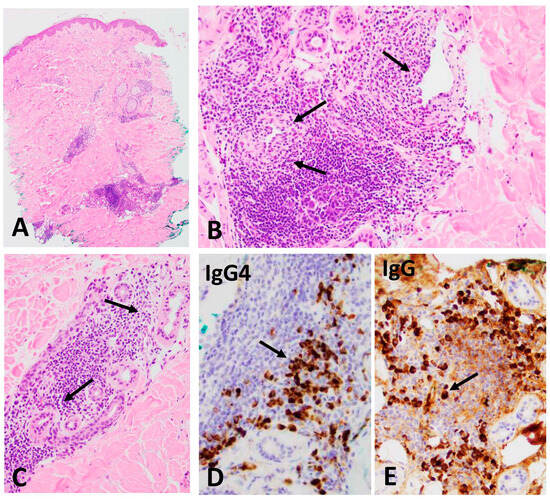 Dermatopathology | Free Full-Text | IgG4-Related Disease (IgG4-RD) with ...