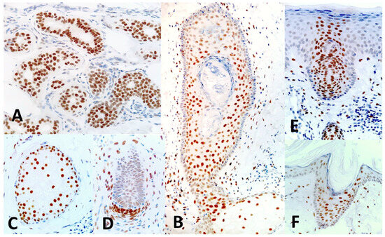 Expression of TRPS1 in Metastatic Tumors of the Skin: An ...
