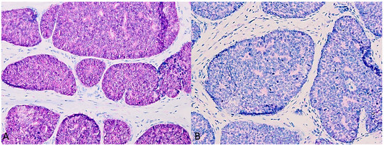 Digital Papillary Adenocarcinoma Is HPV-42-Associated and BRAFV600E Negative: Perspectives for ...