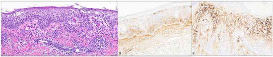 Potential Pitfalls of IgG4 Immunohistochemical Staining on Lesional ...