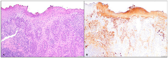 Potential Pitfalls of IgG4 Immunohistochemical Staining on Lesional ...
