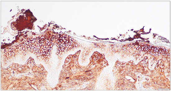 Potential Pitfalls of IgG4 Immunohistochemical Staining on Lesional ...