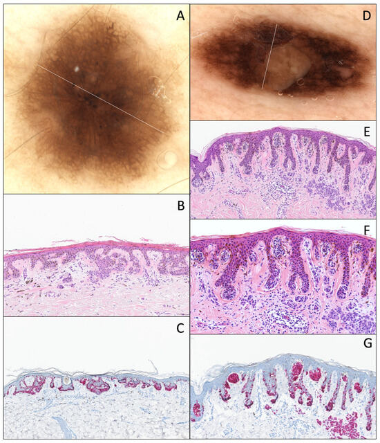 Dysplastic Nevi and Superficial Borderline Atypical Melanocytic Lesions: Description of an ...