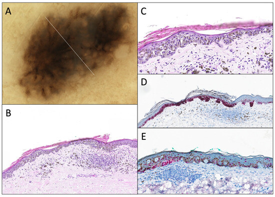 Dysplastic Nevi and Superficial Borderline Atypical Melanocytic Lesions ...
