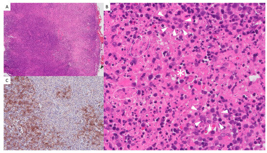 Pediatric Kikuchi–Fujimoto Disease: Case Report and Review of Cutaneous ...