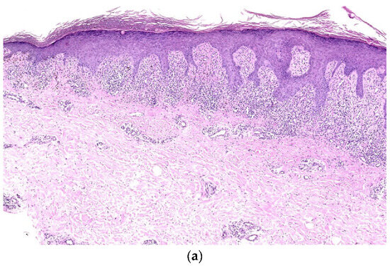 Inflammatory Papillary Hyperplasia Histology