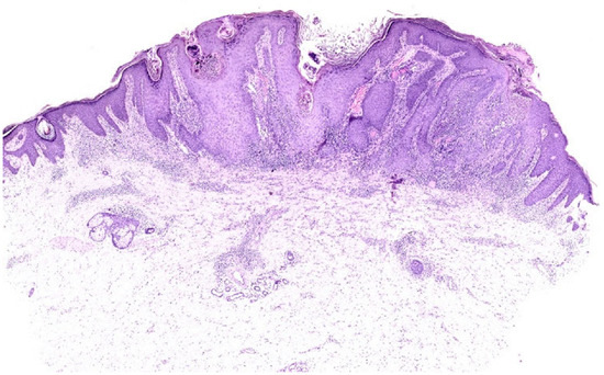 Hypertrophic Lichen Planus and Hypertrophic Skin Lesions Associated ...