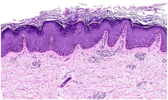 Hypertrophic Lichen Planus and Hypertrophic Skin Lesions Associated ...