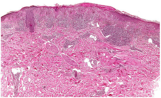 Hypertrophic Lichen Planus and Hypertrophic Skin Lesions Associated ...