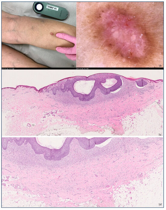 Uncommon Collision Tumors: Dermoscopic and Histopathological Features ...