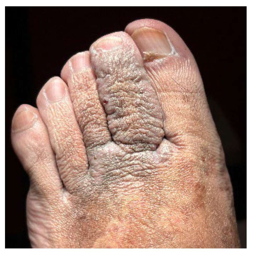 Unilateral Acroangiodermatitis: From Histopathologic Confirmation to ...