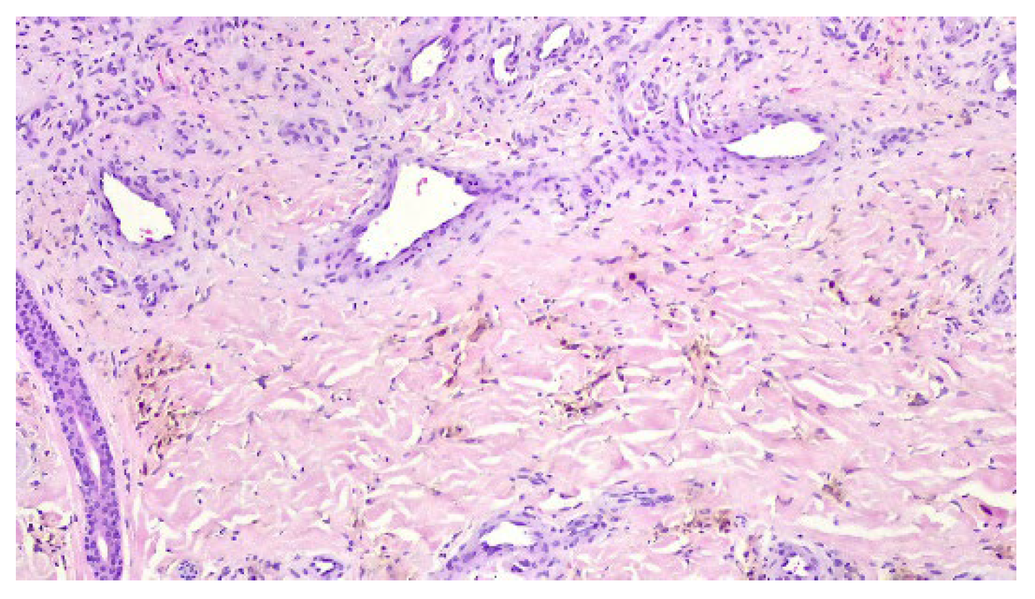 Unilateral Acroangiodermatitis: From Histopathologic Confirmation to ...