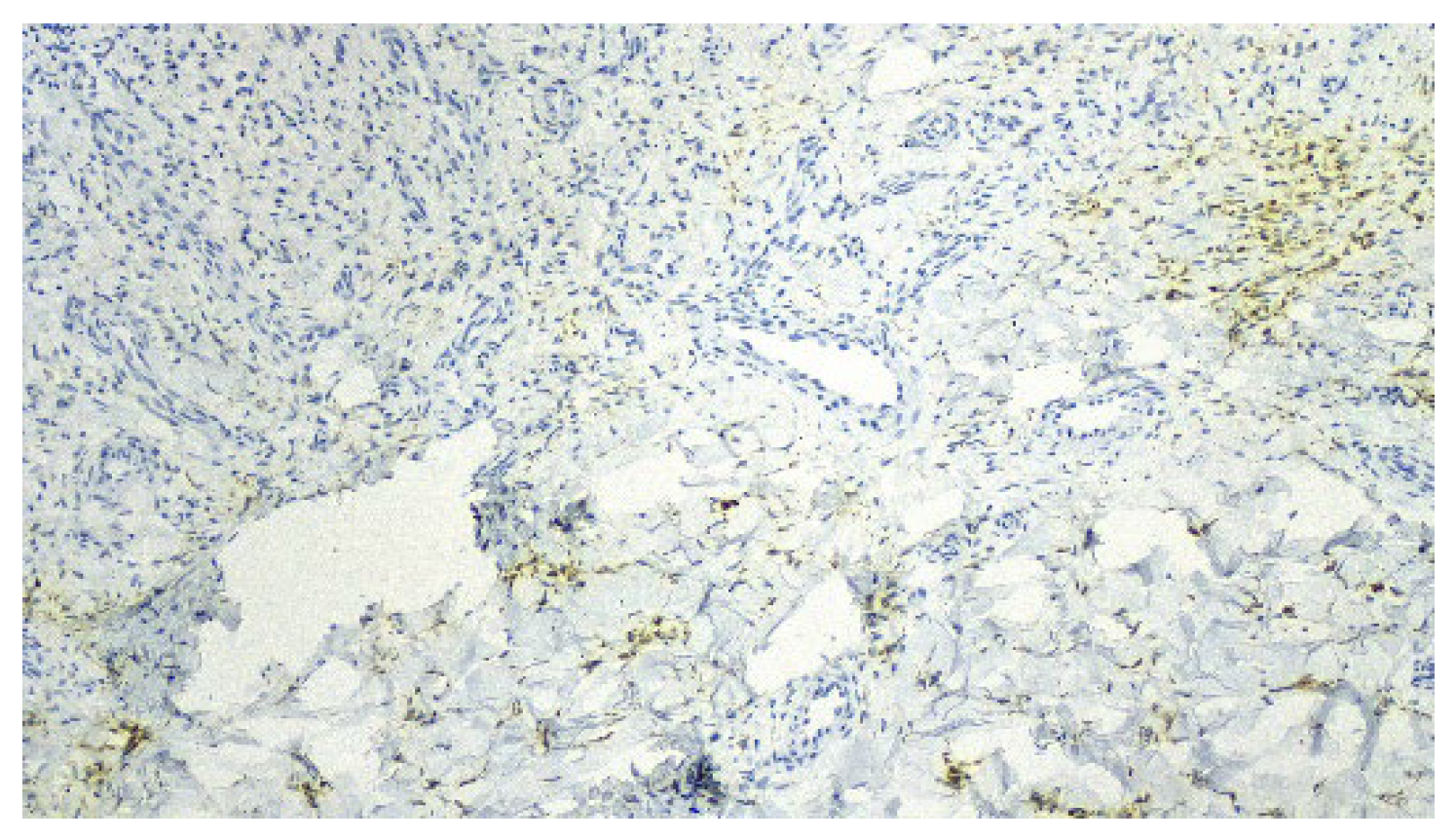 Unilateral Acroangiodermatitis: From Histopathologic Confirmation to ...