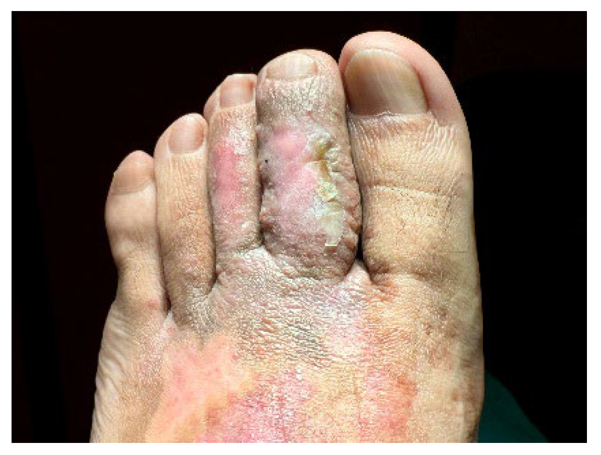 Unilateral Acroangiodermatitis: From Histopathologic Confirmation to ...