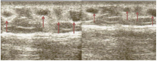 Lipodystrophies from Insulin Injection: An Update of the Italian ...