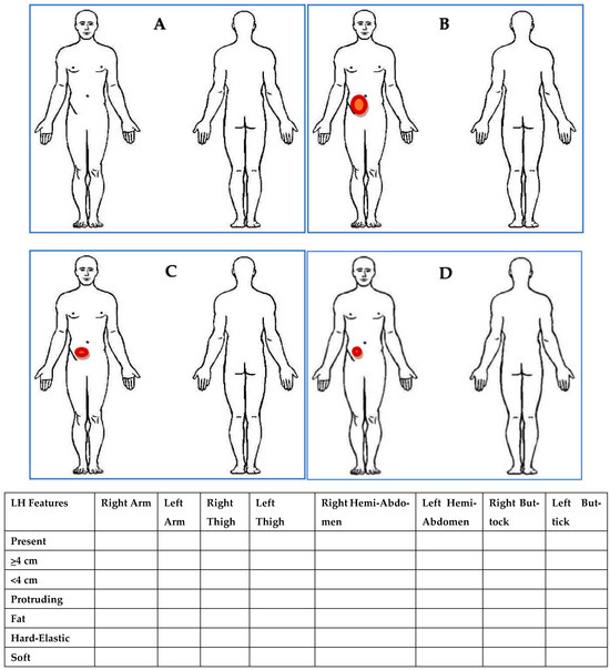 A Neglected Complication of Insulin Therapy Due to Errors in Injection ...