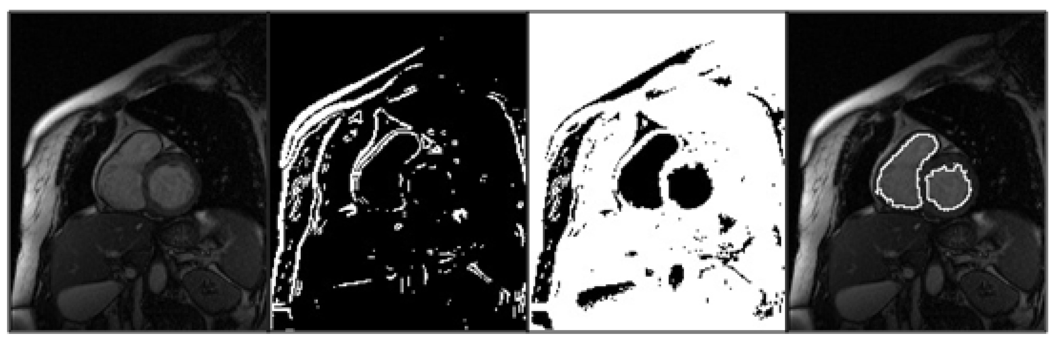 Quantification of Right and Left Ventricular Function in Cardiac MR Imaging: Comparison of ...